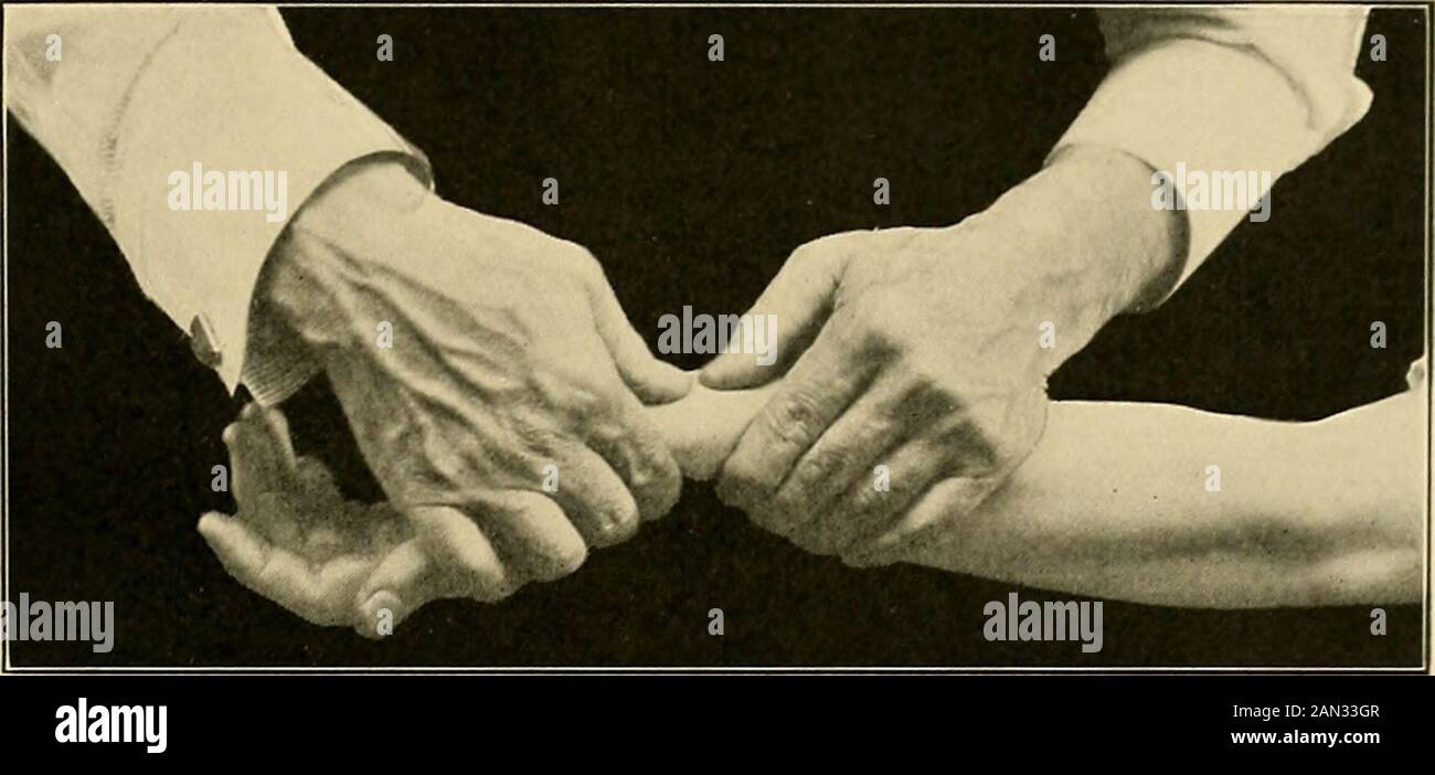 Colles fracture hi-res stock photography and images - Alamy