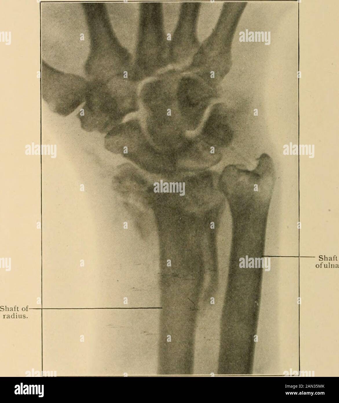 The treatment of fractures . fig. 305.—Colles fracture, with fracture ...