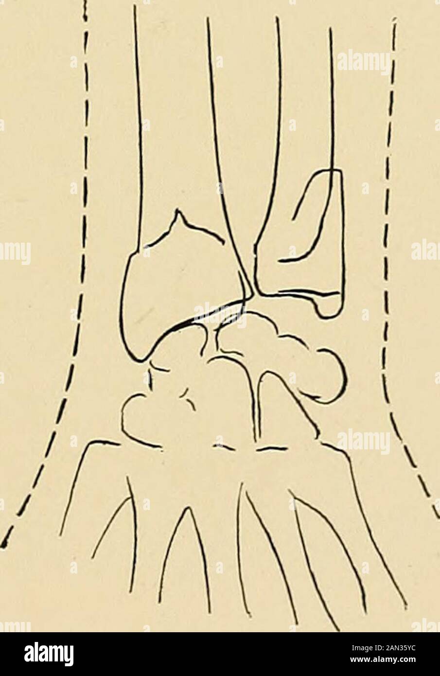 The treatment of fractures . I Radial epiphysis, inner : fragment. Q--t ...