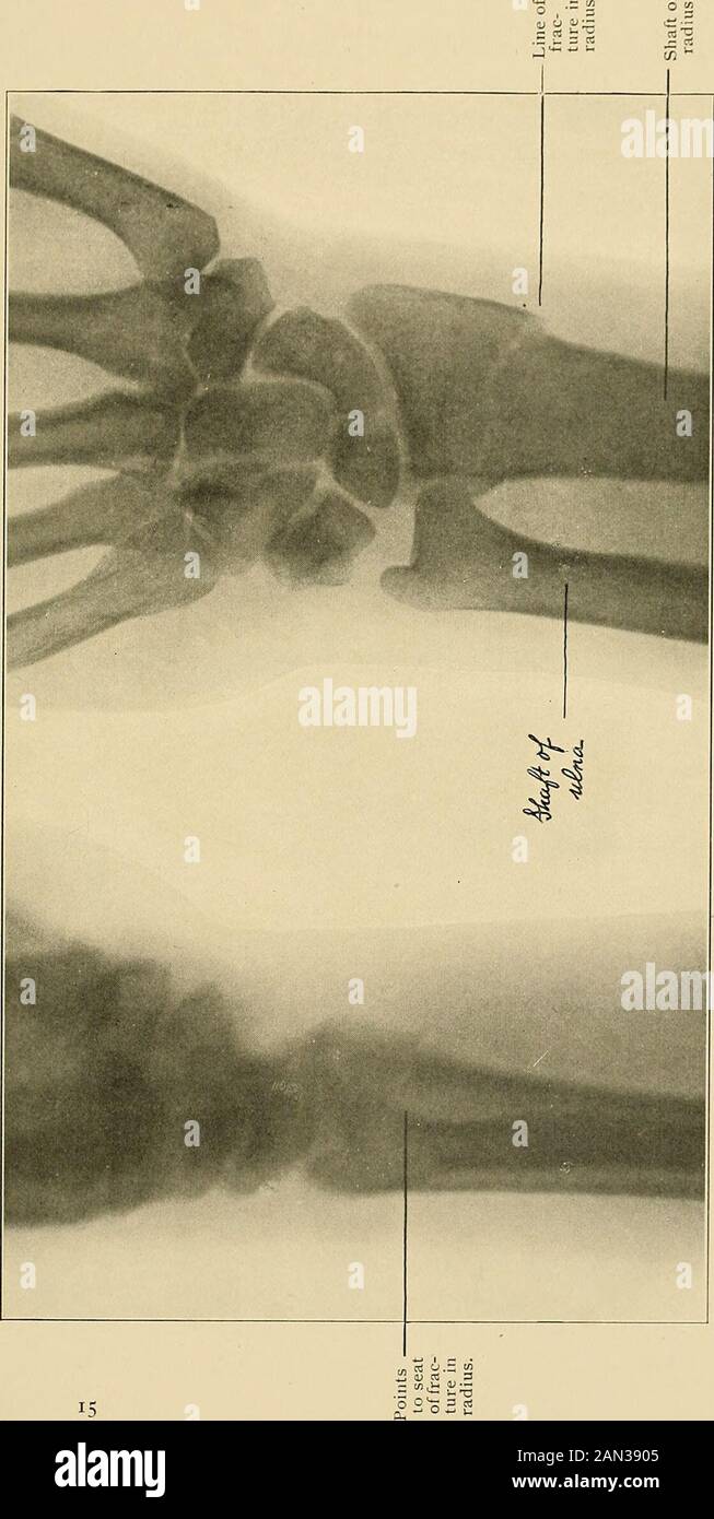The treatment of fractures . Fig. 295.—Simple transverse Colles ...