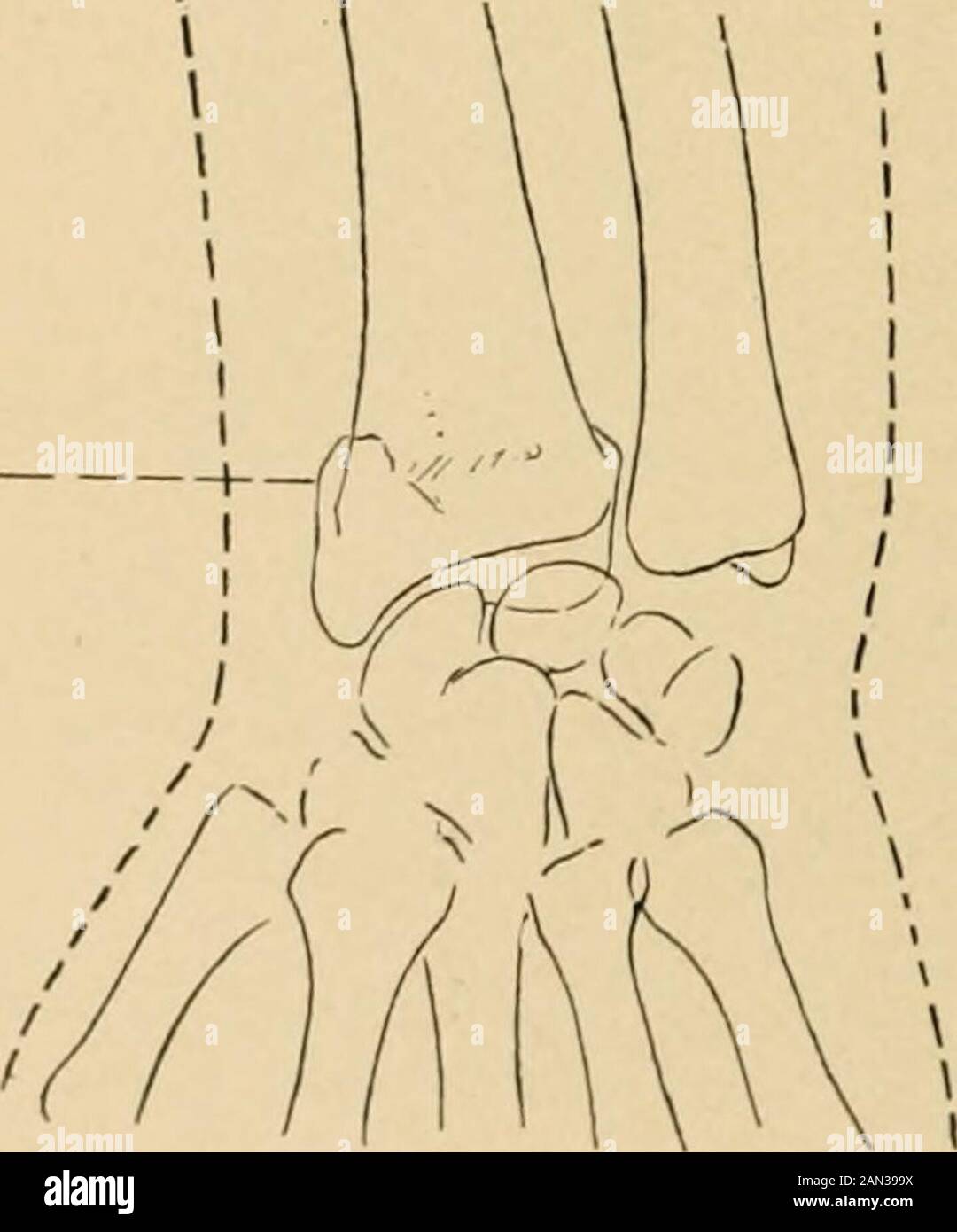 The treatment of fractures . First metacarpal. Carpus. Styloid of ...