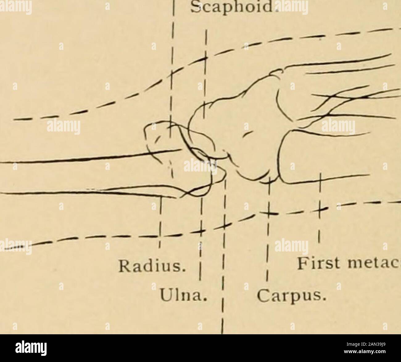 The treatment of fractures . d process of ulna. Fig. 293.—Colles ...