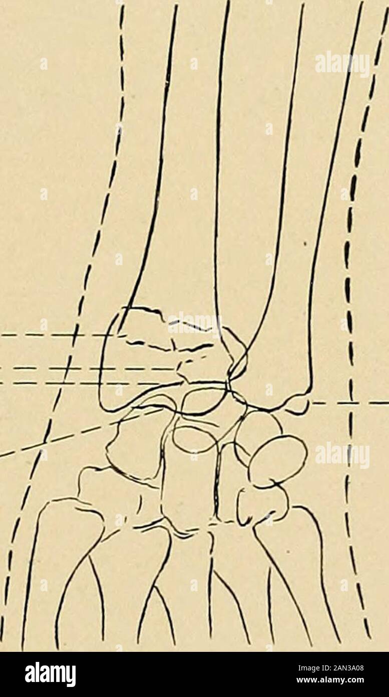 The treatment of fractures . Fig. 292.—A form of comminution in Colles ...