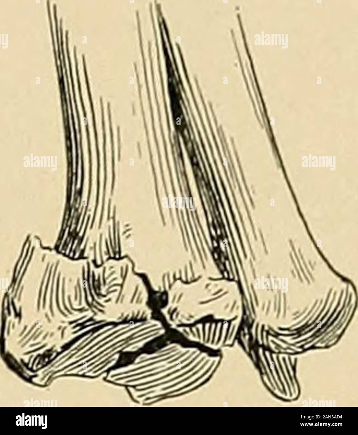 Colles fracture hi-res stock photography and images - Alamy