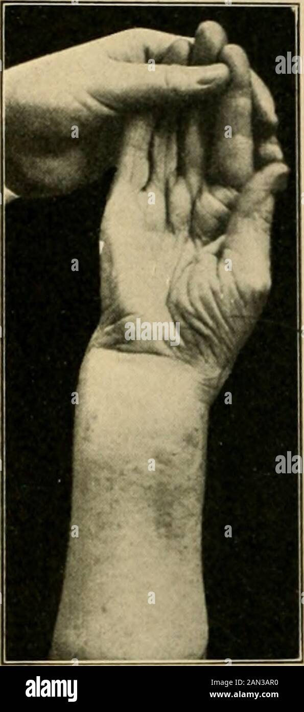 Thenar prominence hi-res stock photography and images - Alamy