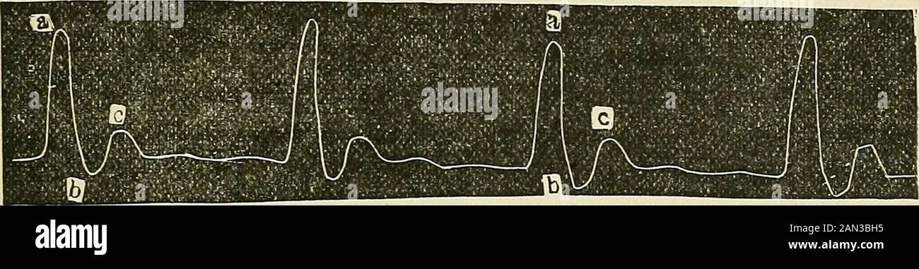 Ventricular diastole hi-res stock photography and images - Alamy