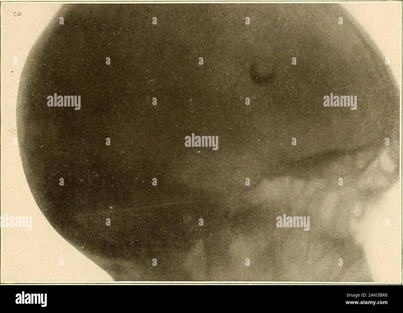 Enostosis hi-res stock photography and images - Alamy