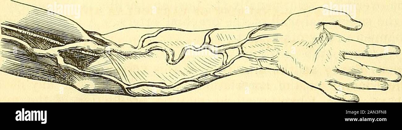 Spurious vein hi-res stock photography and images - Alamy