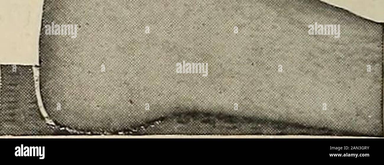 Nervous and mental diseases . Fig. 195.—Tabetic feet. 1 and 3 show ...