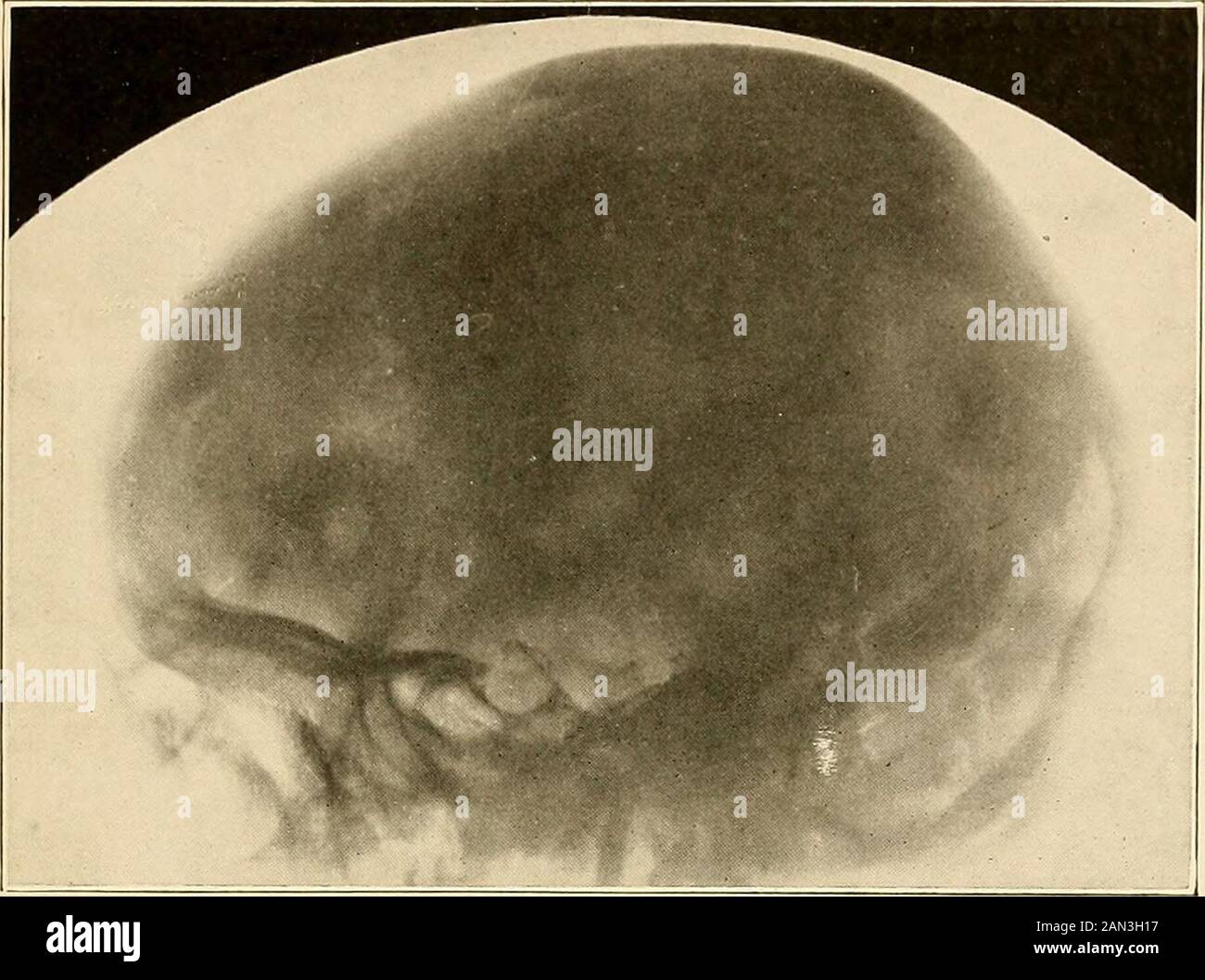 Roentgen diagnosis of diseases of the head . acusticus tumor with ...