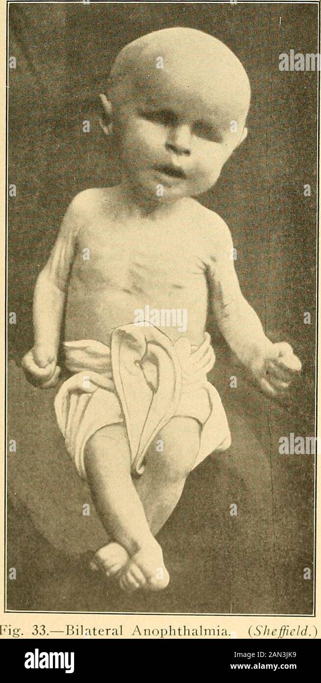 Cretinism hi-res stock photography and images - Alamy