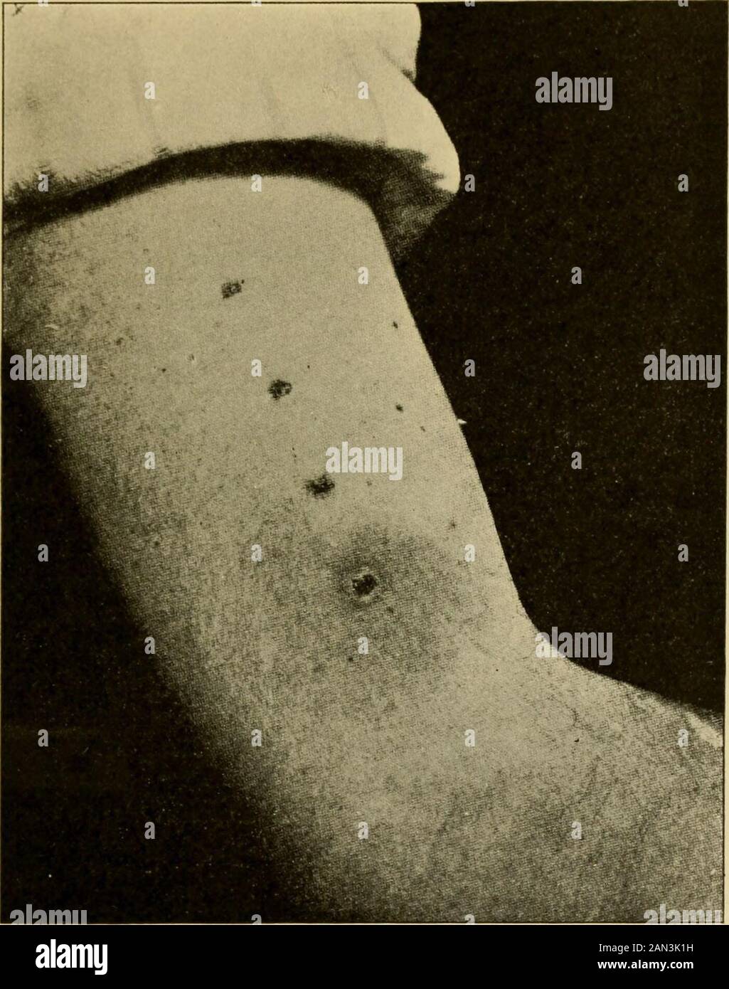 Handbook of medical entomology . jection of a foreign protein bythe fly ...