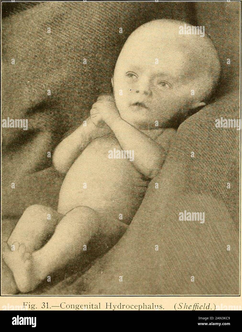 Congenital hydrocephalus hi-res stock photography and images - Alamy