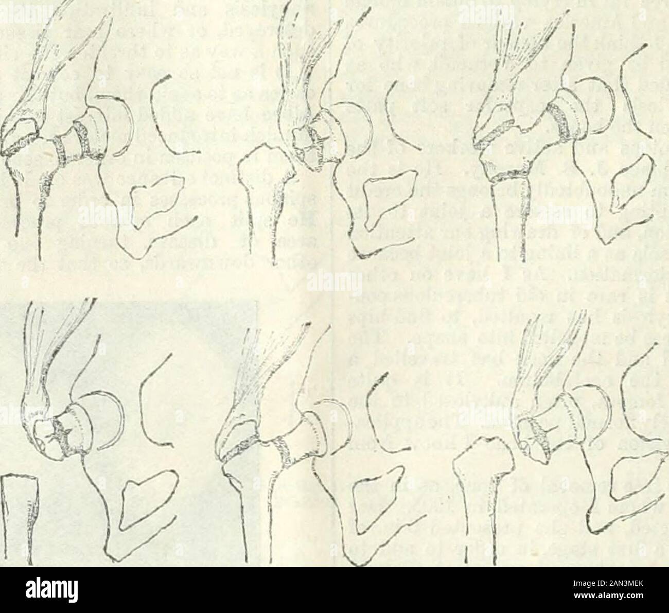 Trochanter Roll Placement
