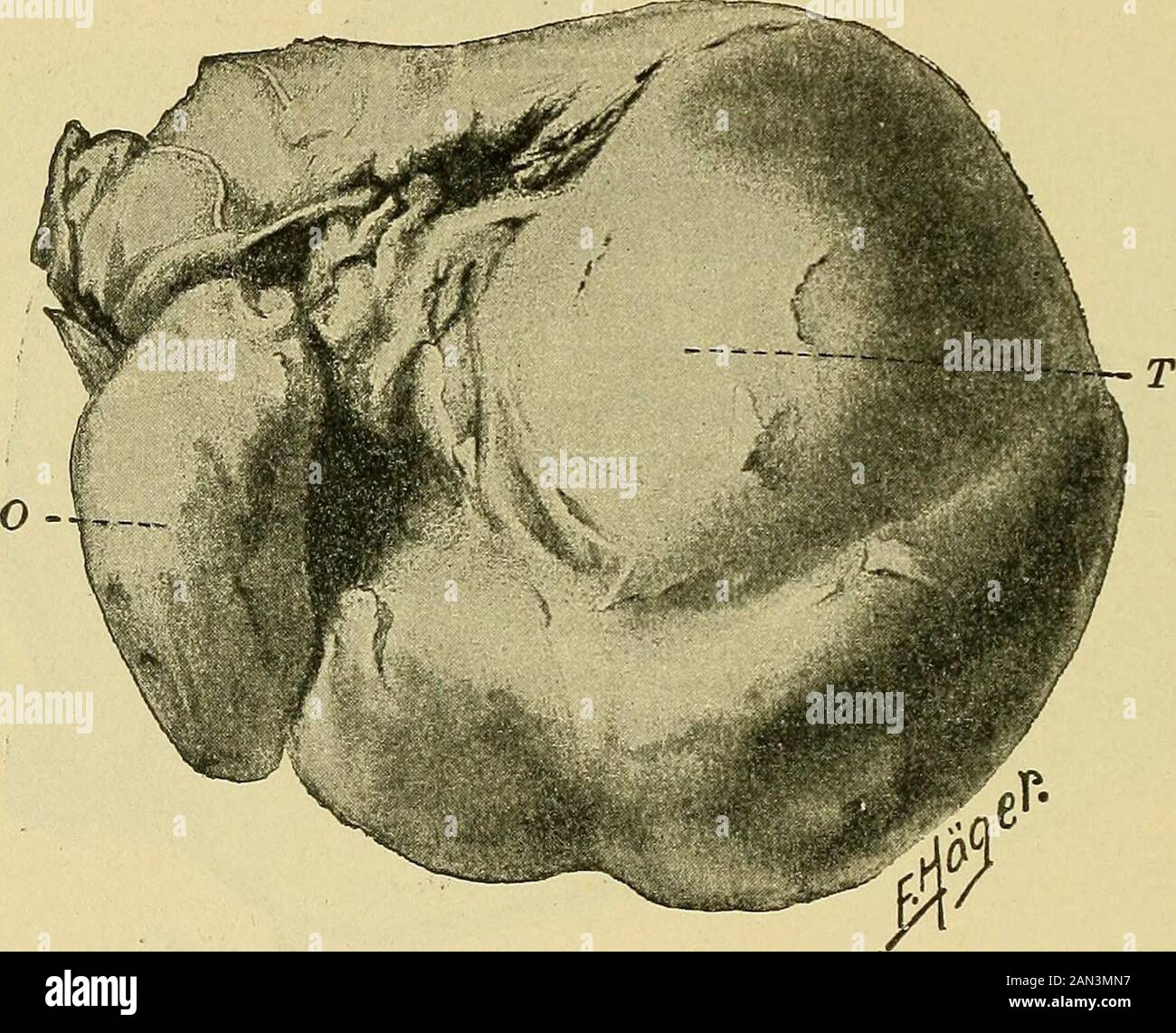Fetal sac hi-res stock photography and images - Alamy