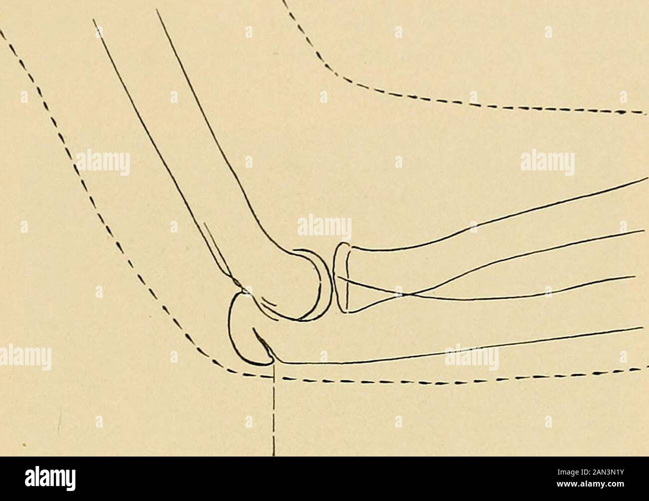 Epiphyseal fracture x ray hi-res stock photography and images - Alamy