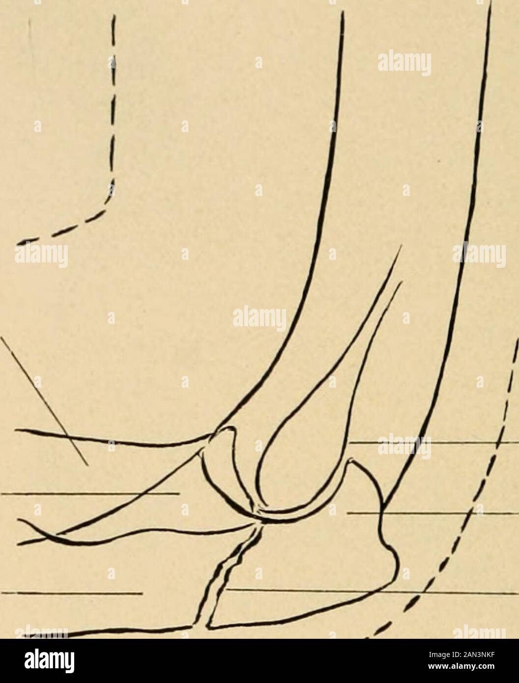 The treatment of fractures . Seat of fracture. Fig. 272.—Splintered ...