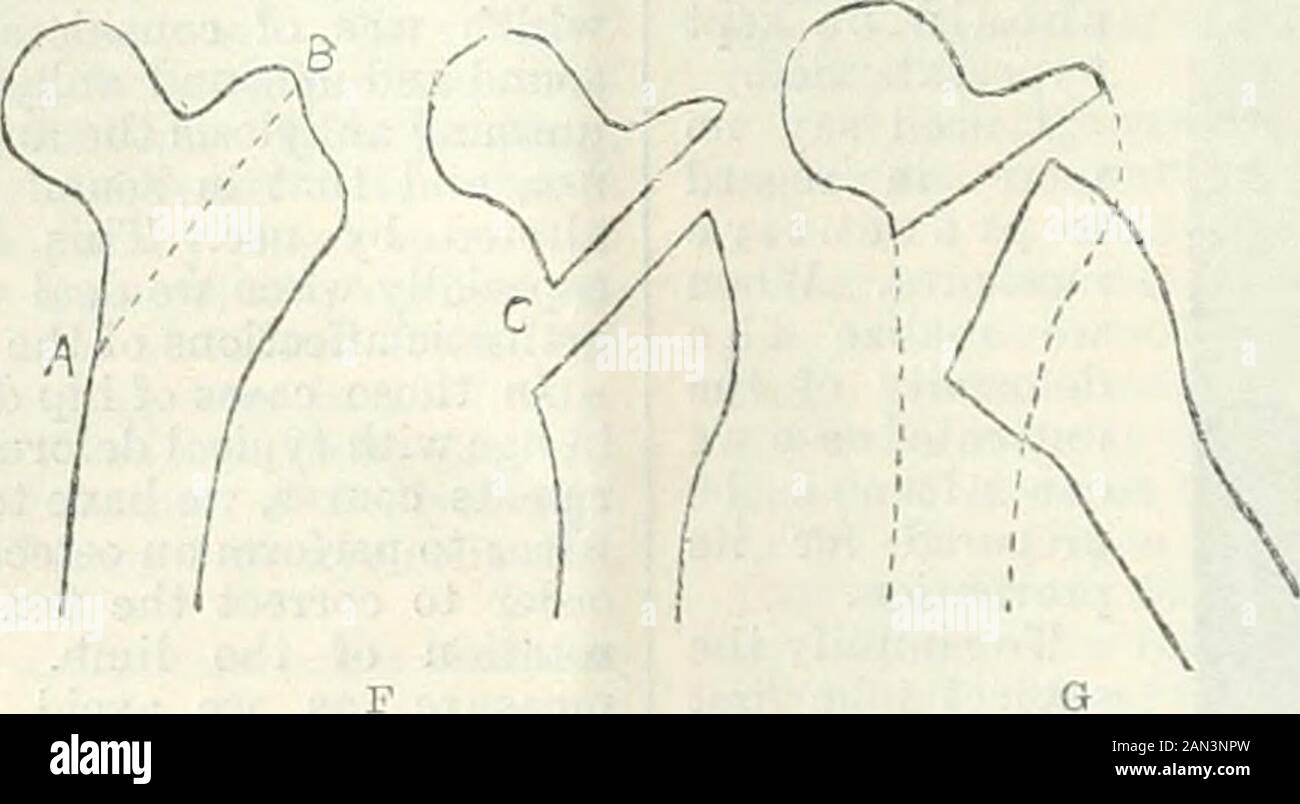 Pedunculated hi-res stock photography and images - Alamy