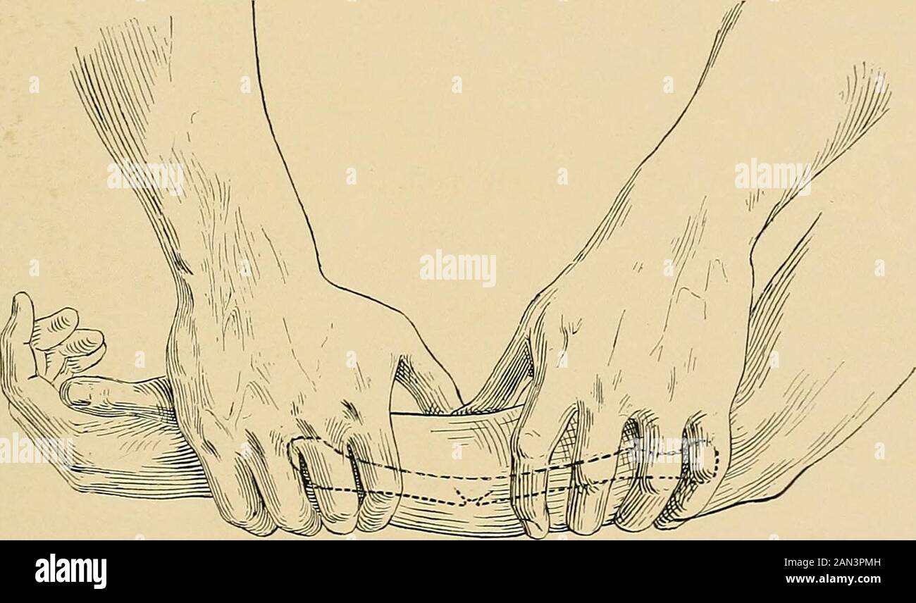 Compound fracture hi-res stock photography and images - Alamy