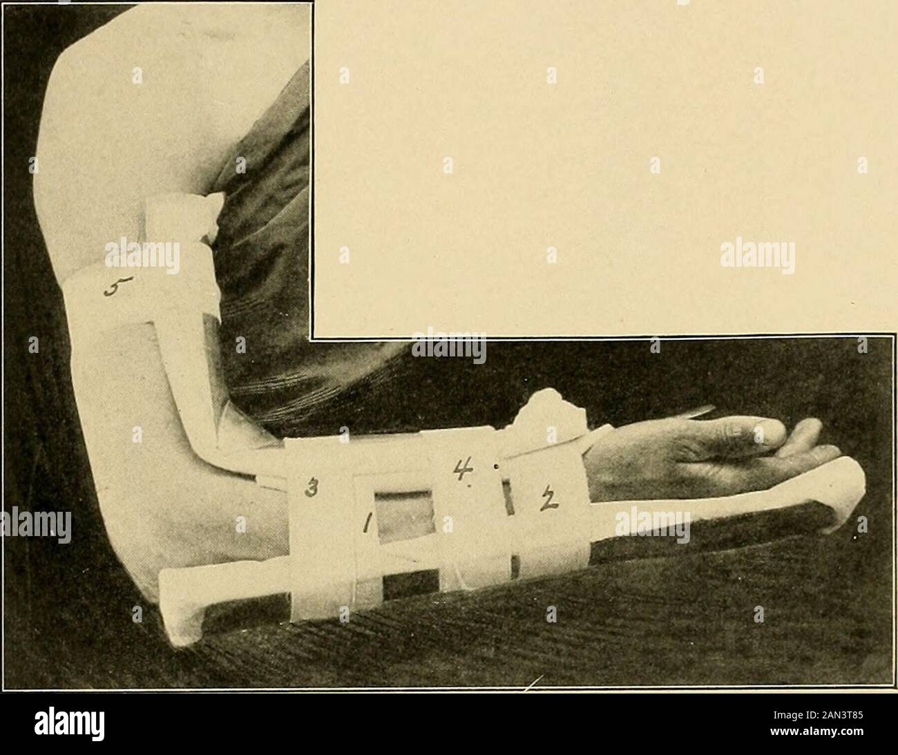 The treatment of fractures . is necessary to maintain thisposition ...