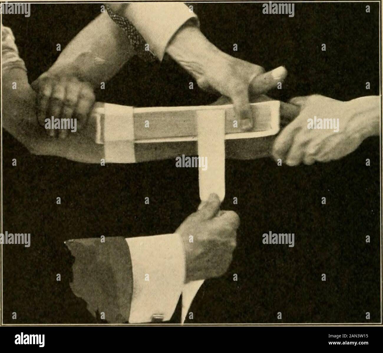 The treatment of fractures . Fig. 261.—Fracture of the forearm low down ...