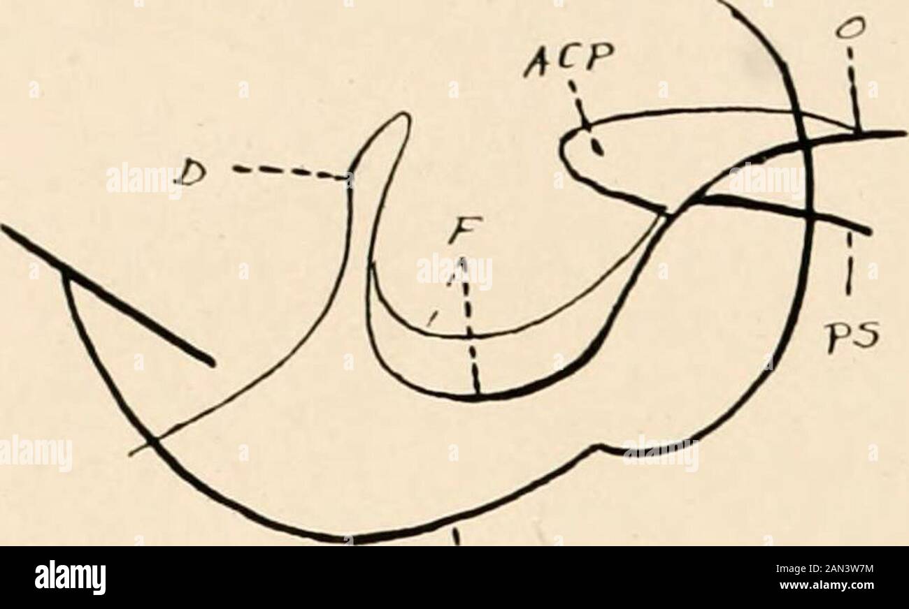 Roentgen diagnosis of diseases of the head . Fig. 50.—A sketch of Fig ...