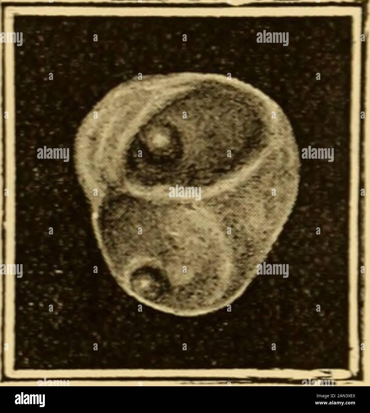 Otorrhea hi-res stock photography and images - Alamy