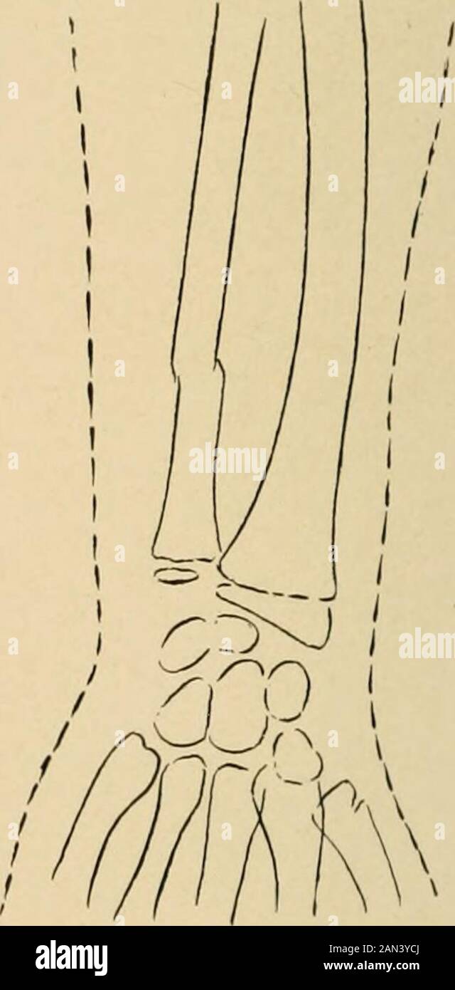 The treatment of fractures . Fig. 254.—Old fracture of both bonesof the ...