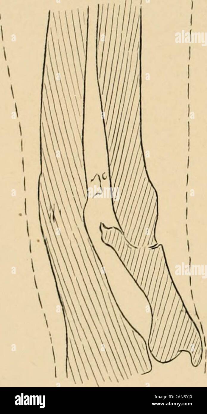The treatment of fractures . splint should be applied. It should extend ...
