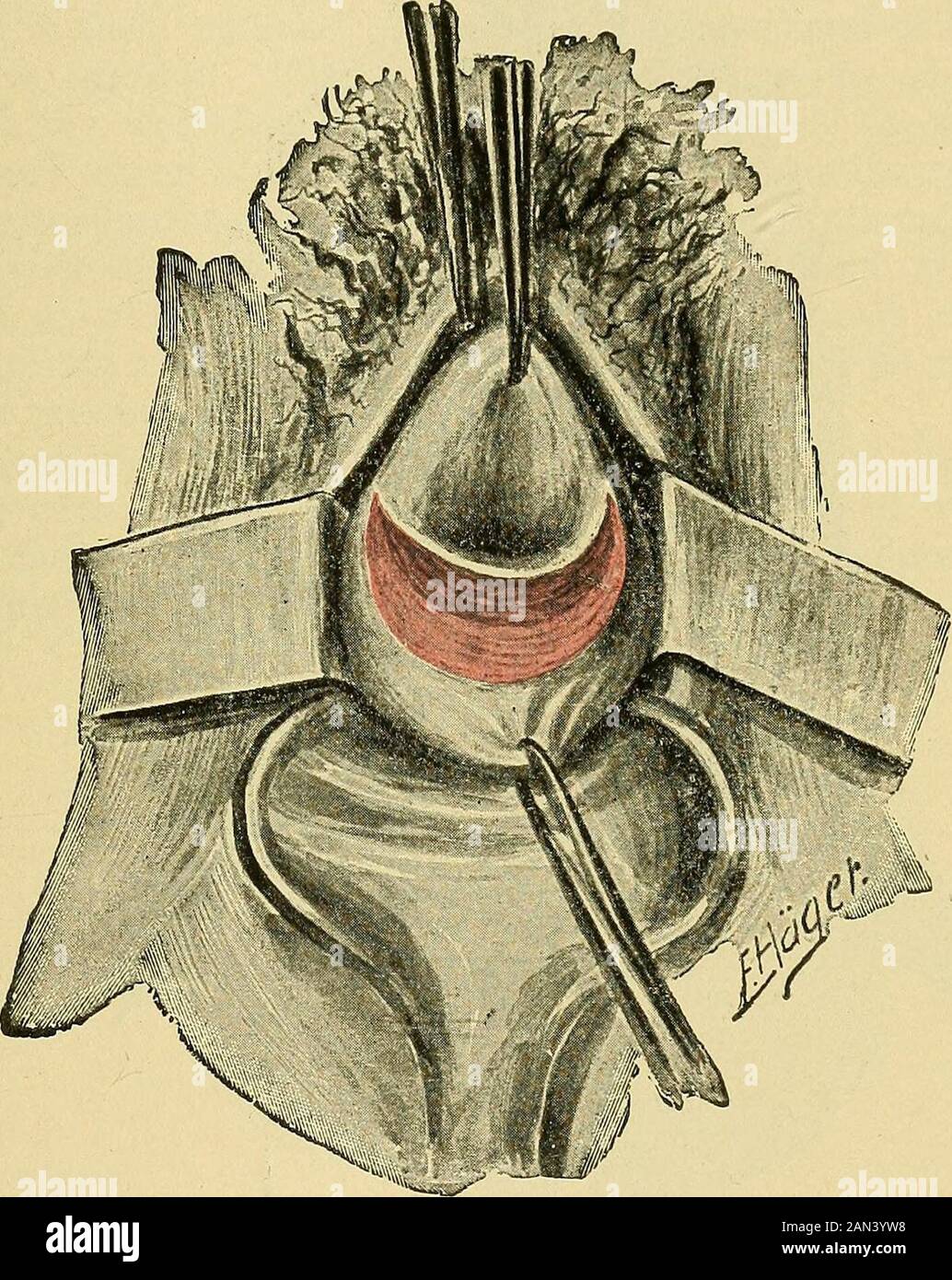 Pathology and treatment of diseases of women . of the cervical lips is ...