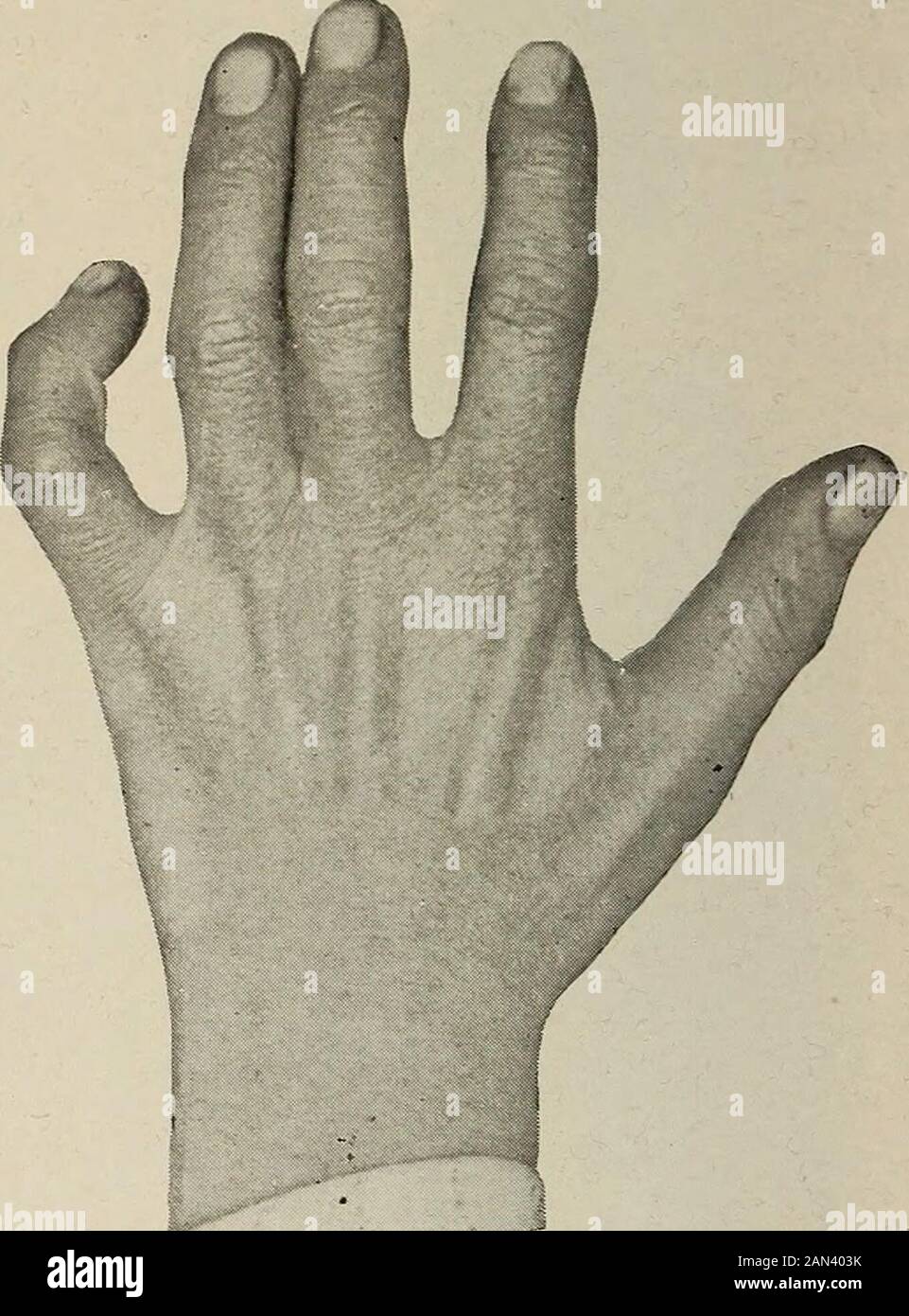 Nervous and mental diseases . Fig. 158.—Hand in early amyotrophic ...