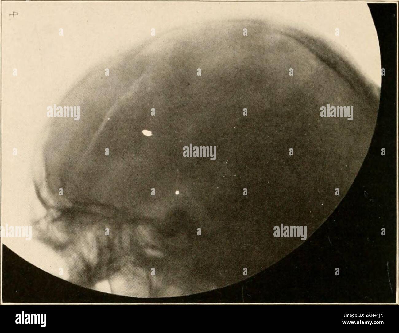 Skull Fracture Calcification