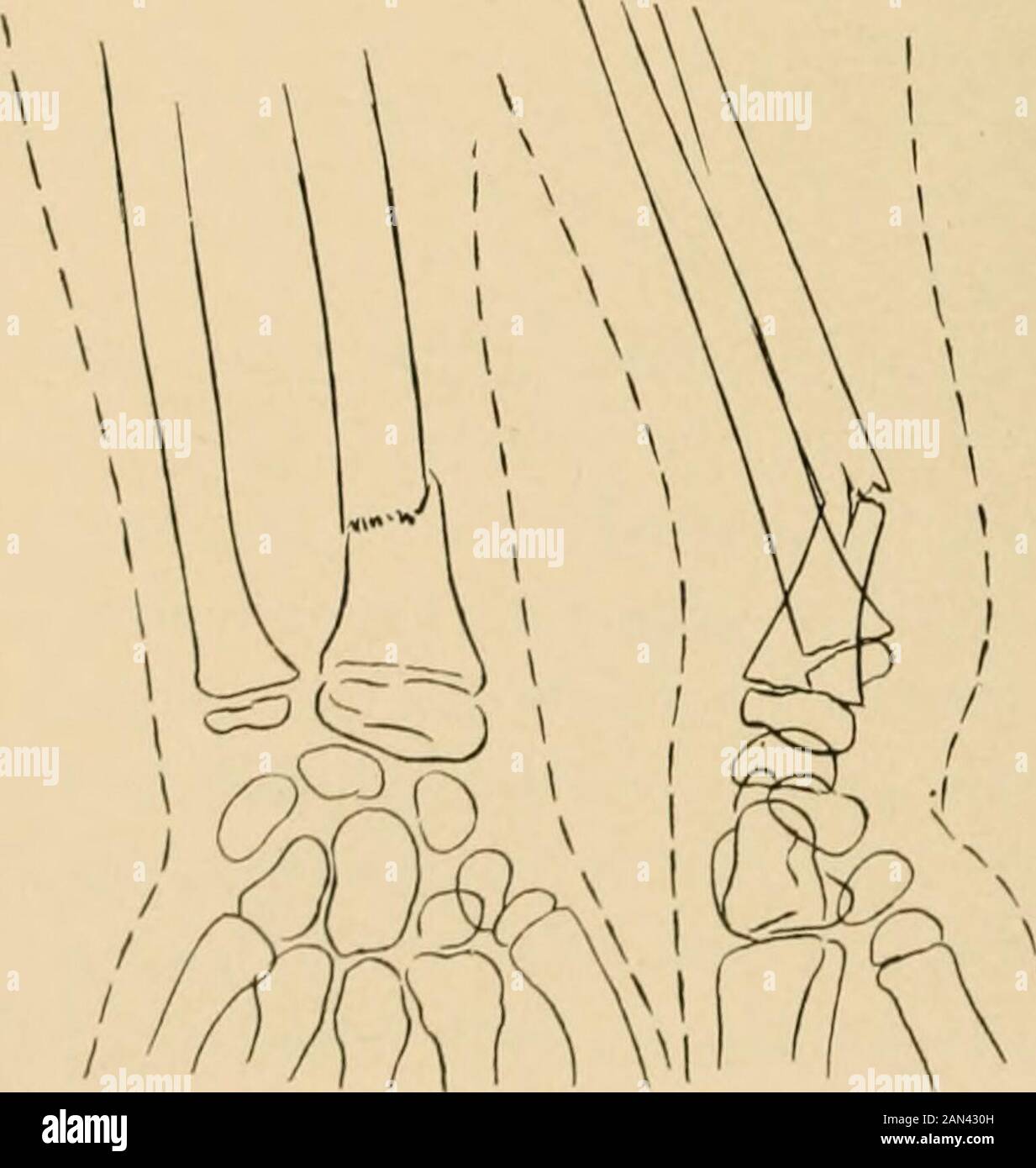The treatment of fractures . Fig. 23S.—Fracture of both bones of ...