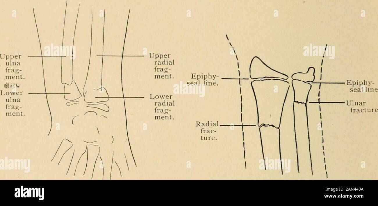 Radial head subluxation hi-res stock photography and images - Alamy