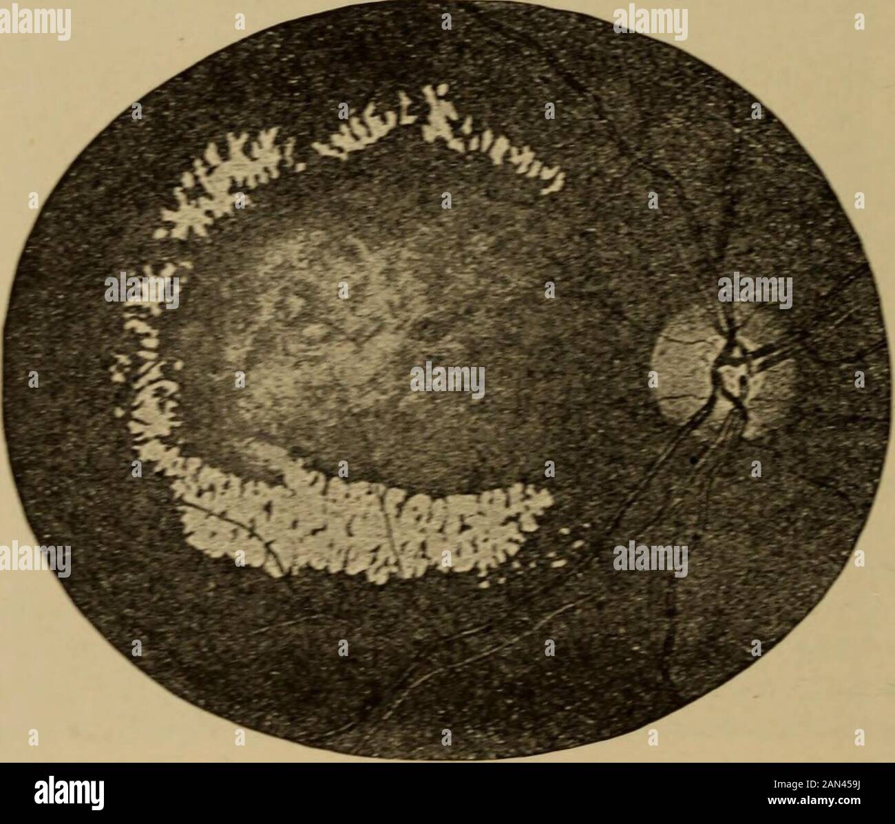 Text-book of ophthalmology . ditions are very chronicand in both ...