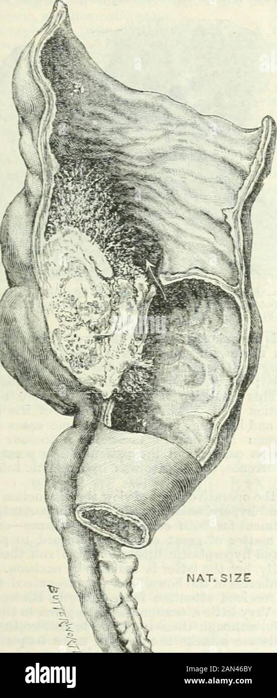 British medical journal . y OConnor au inverted diverticulum caused ...