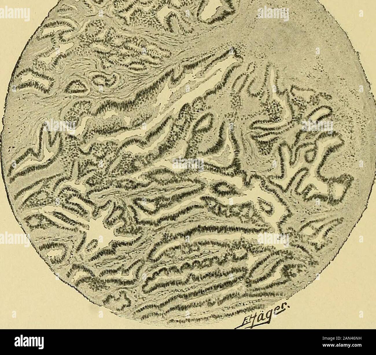 Metaplastic hi-res stock photography and images - Alamy