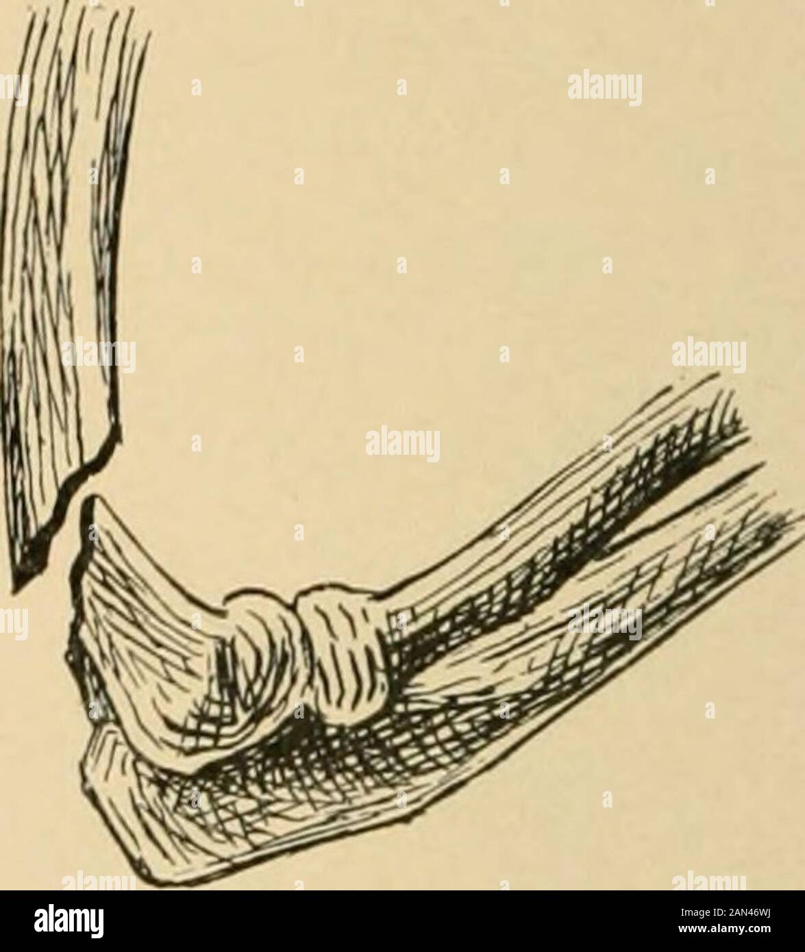 The treatment of fractures . 1 ig. 229.—Supi acondyloid fracture. Ob ...