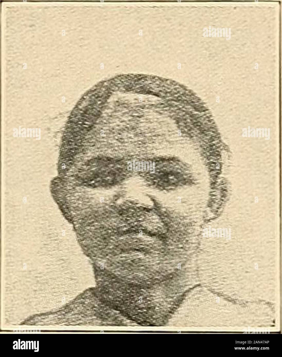 Cretinism hi-res stock photography and images - Alamy