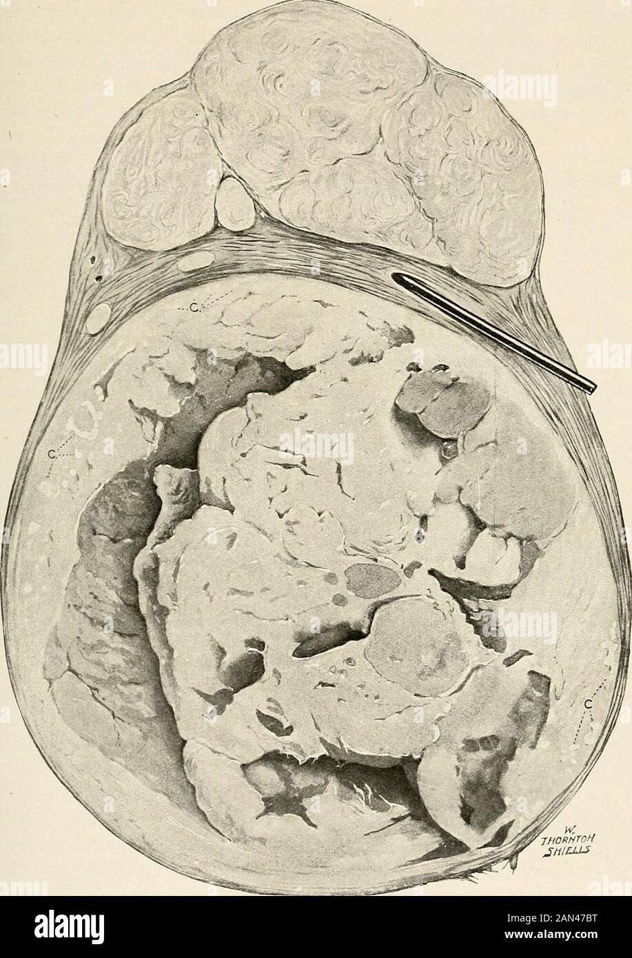 Gynaecology for students and practitioners . culties of removal, they ...
