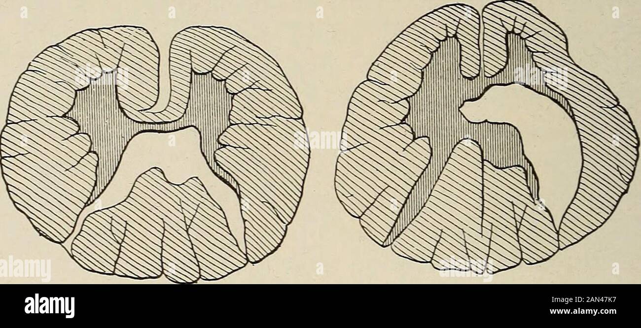 Nervous and mental diseases . Fig. 144.—Sections of a syringomyelic ...