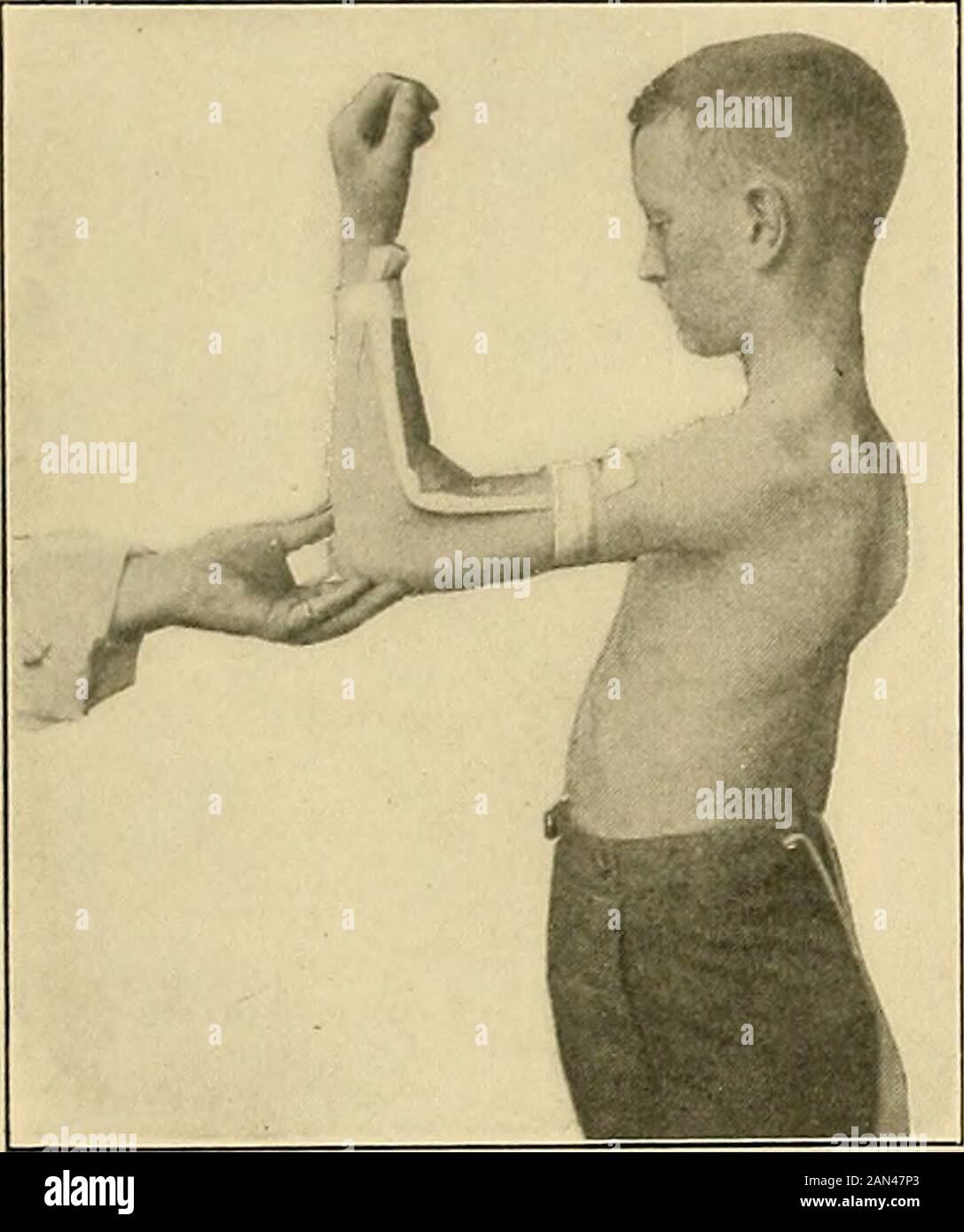 Coronoid process of ulna hi-res stock photography and images - Alamy