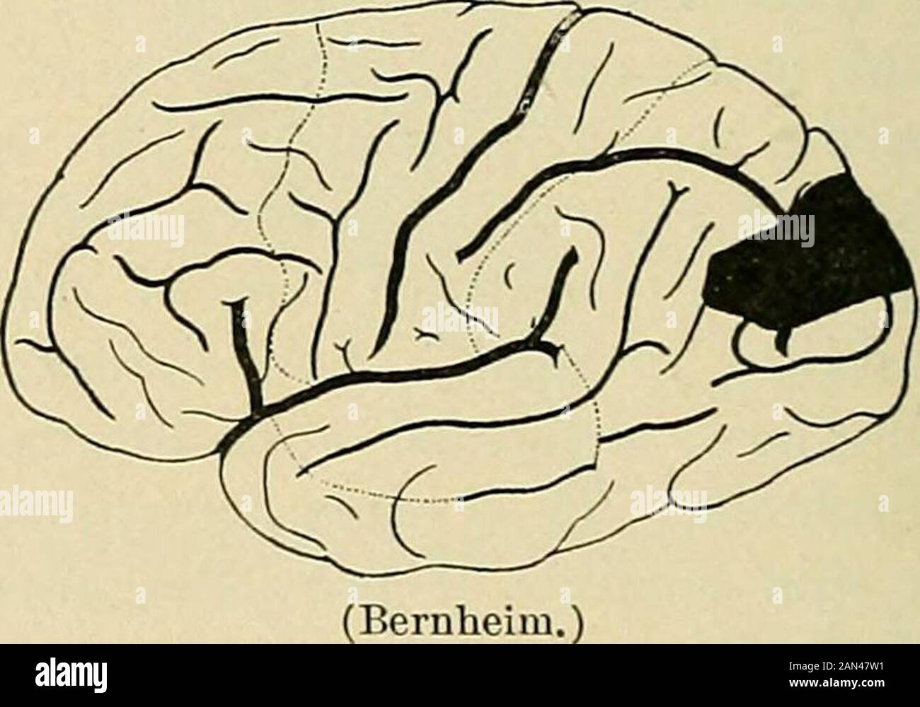 Jacksonian epilepsy hi-res stock photography and images - Alamy