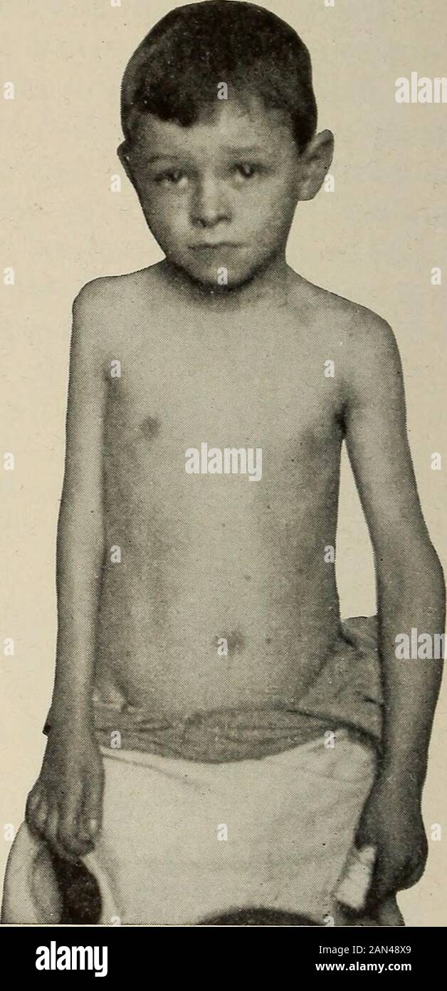 Nervous and mental diseases . Fig. 142.—Deformity of foot afterlumbar ...