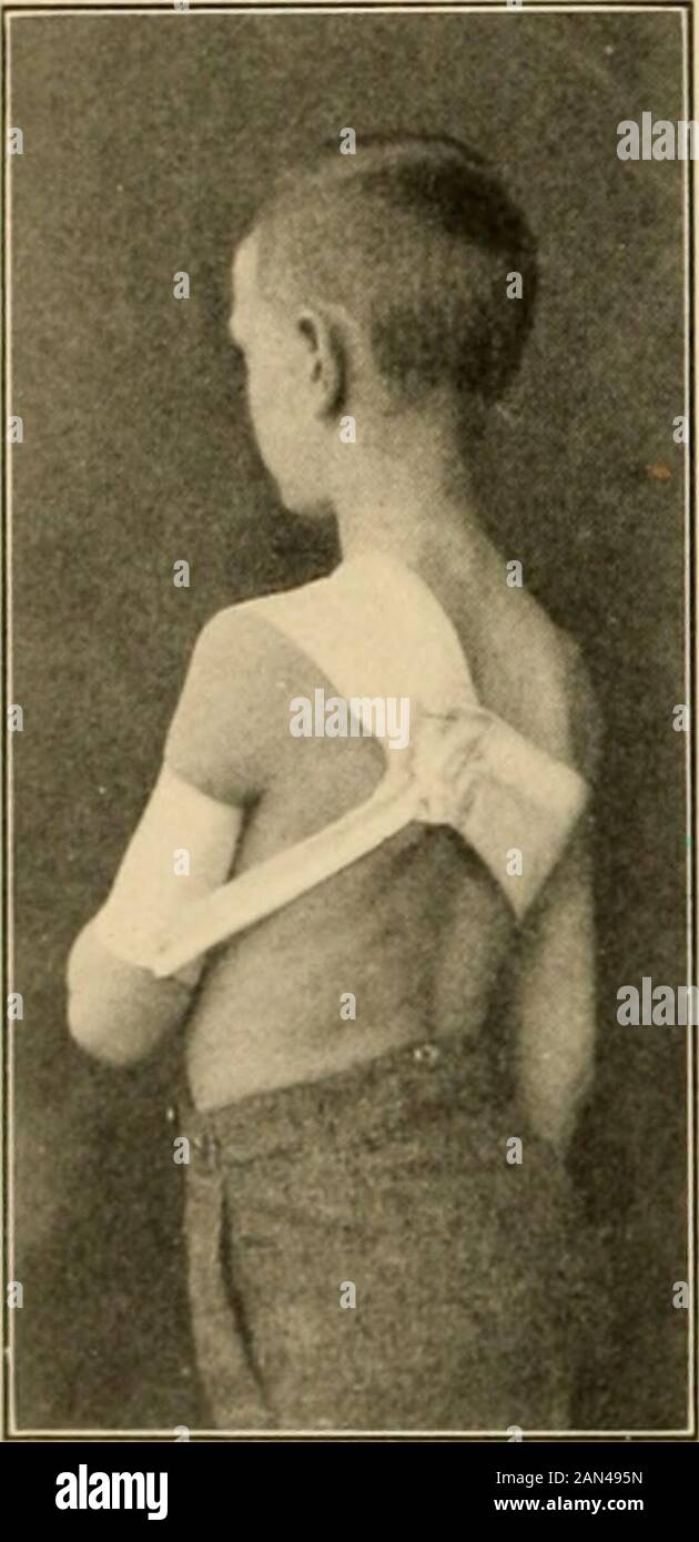 The treatment of fractures . Fig. 222.—Applying figure-of-eight cravat ...