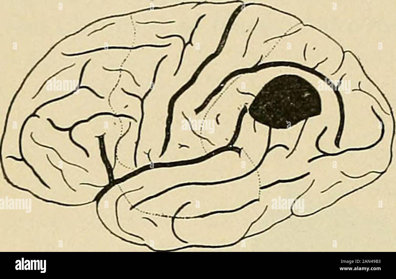 Alexia without agraphia hi-res stock photography and images - Alamy