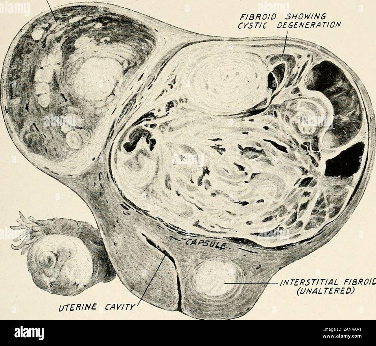 Gynaecology for students and practitioners . Fatty Fibroid. The large ...