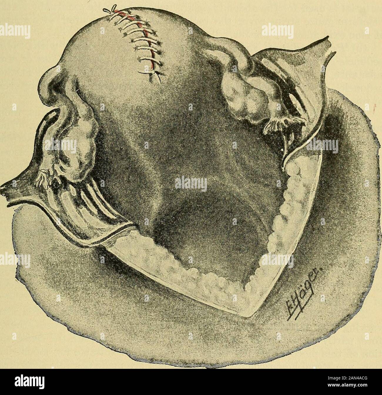 Pathology and treatment of diseases of women . (Abdominal operation ...