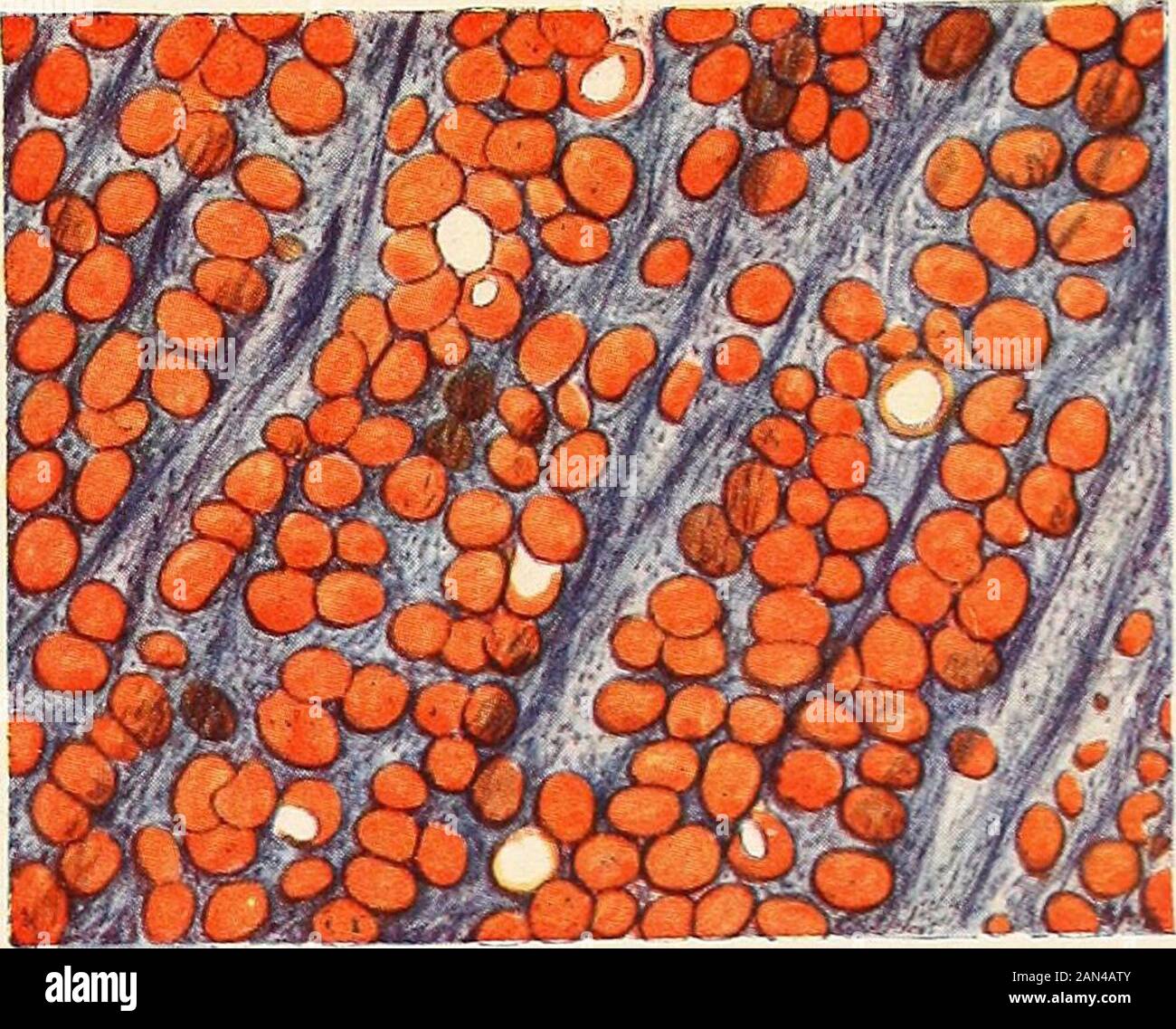Gynaecology for students and practitioners . Fatty Fibroid. Fat ...