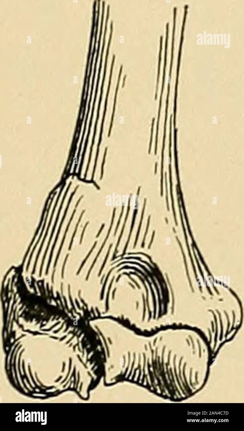 The treatment of fractures . pitellnm. 1 1Radial epiphysis. Fig. 214 ...